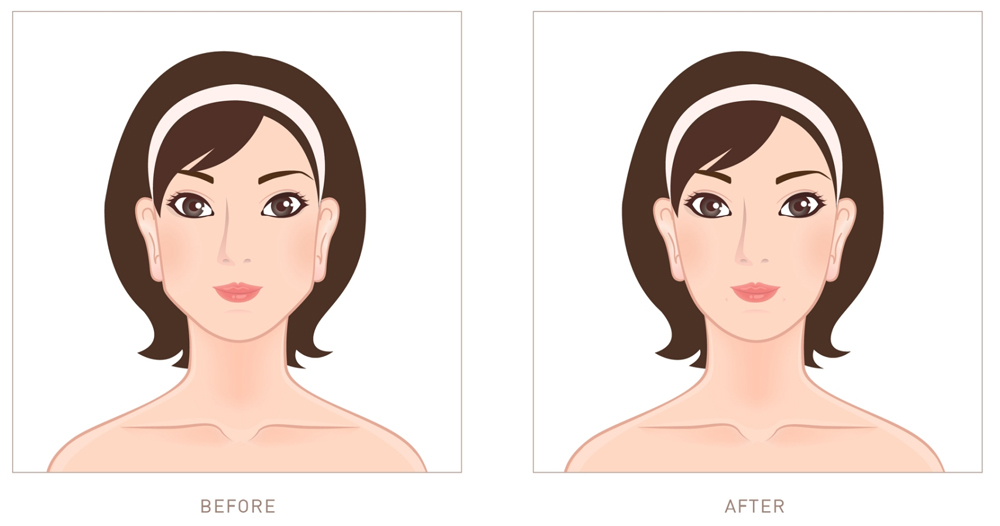 ตัดกรามและกระดูกใบหน้า(Gonioplasty) - BCS clinic